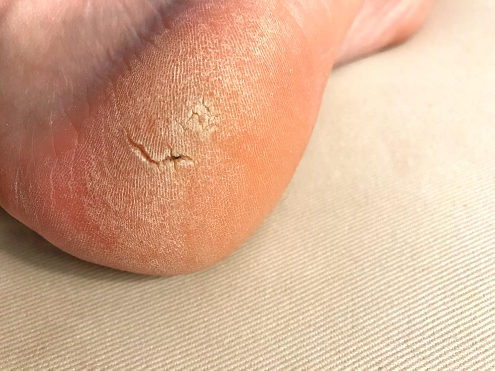 Calluses in Ocoee, FL | Advanced Foot & Ankle of Central Florida